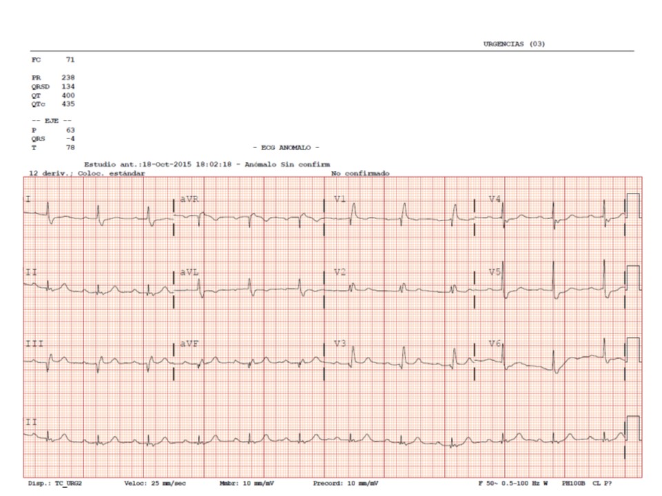 Un caso de SCASEST y tratamiento con Ticagrelor. Caso 17 | cardiomap