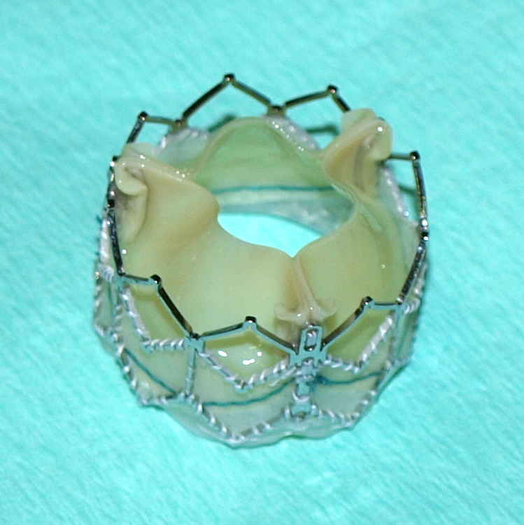 Implante percutáneo de válvula aórtica. Todo lo que necesito saber ...