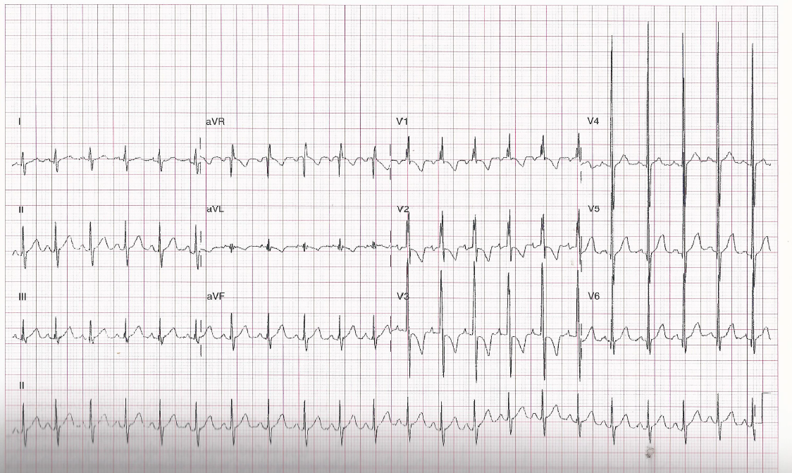 ECG de hipertrofia biventricular | cardiomap