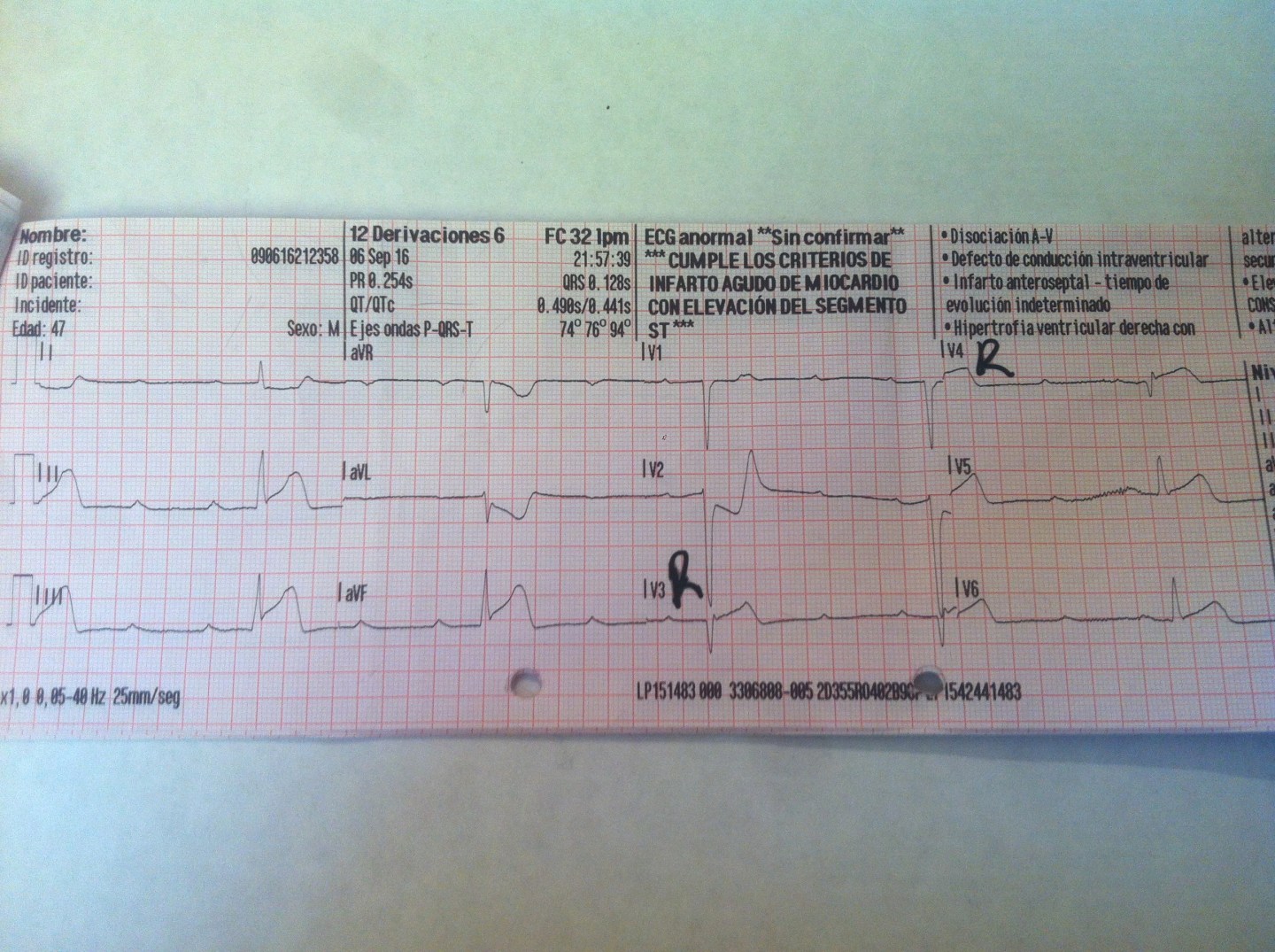 Bloqueo AV completo en IAM inferior. Caso 22 | cardiomap