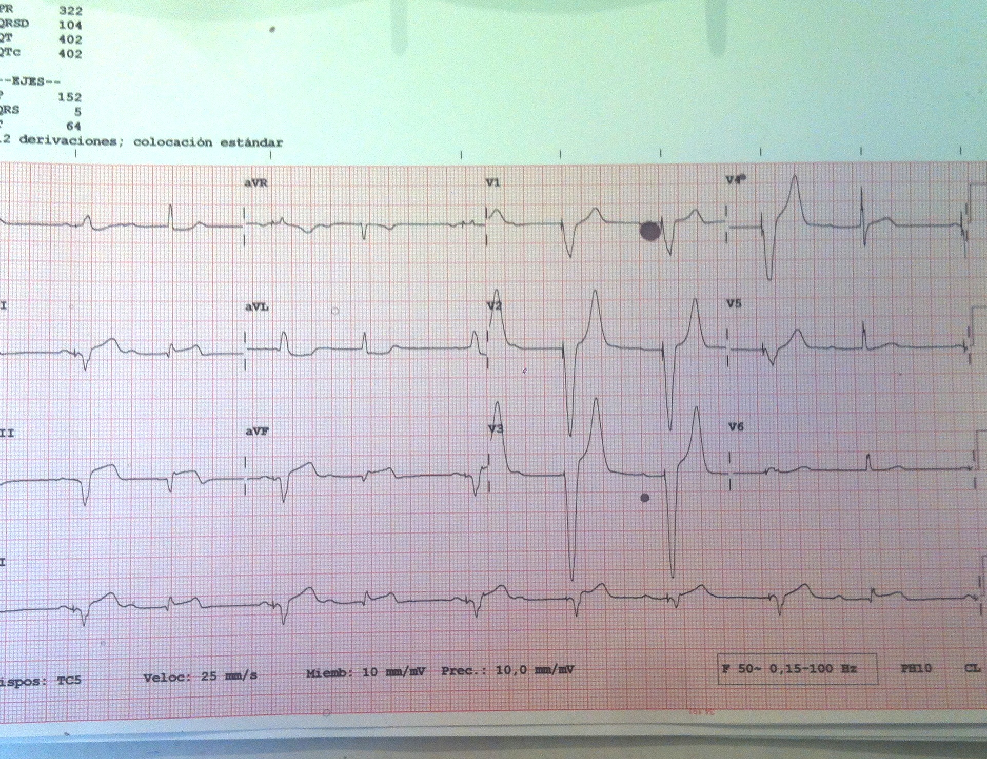 Bloqueo AV completo en IAM inferior. Caso 22 | cardiomap