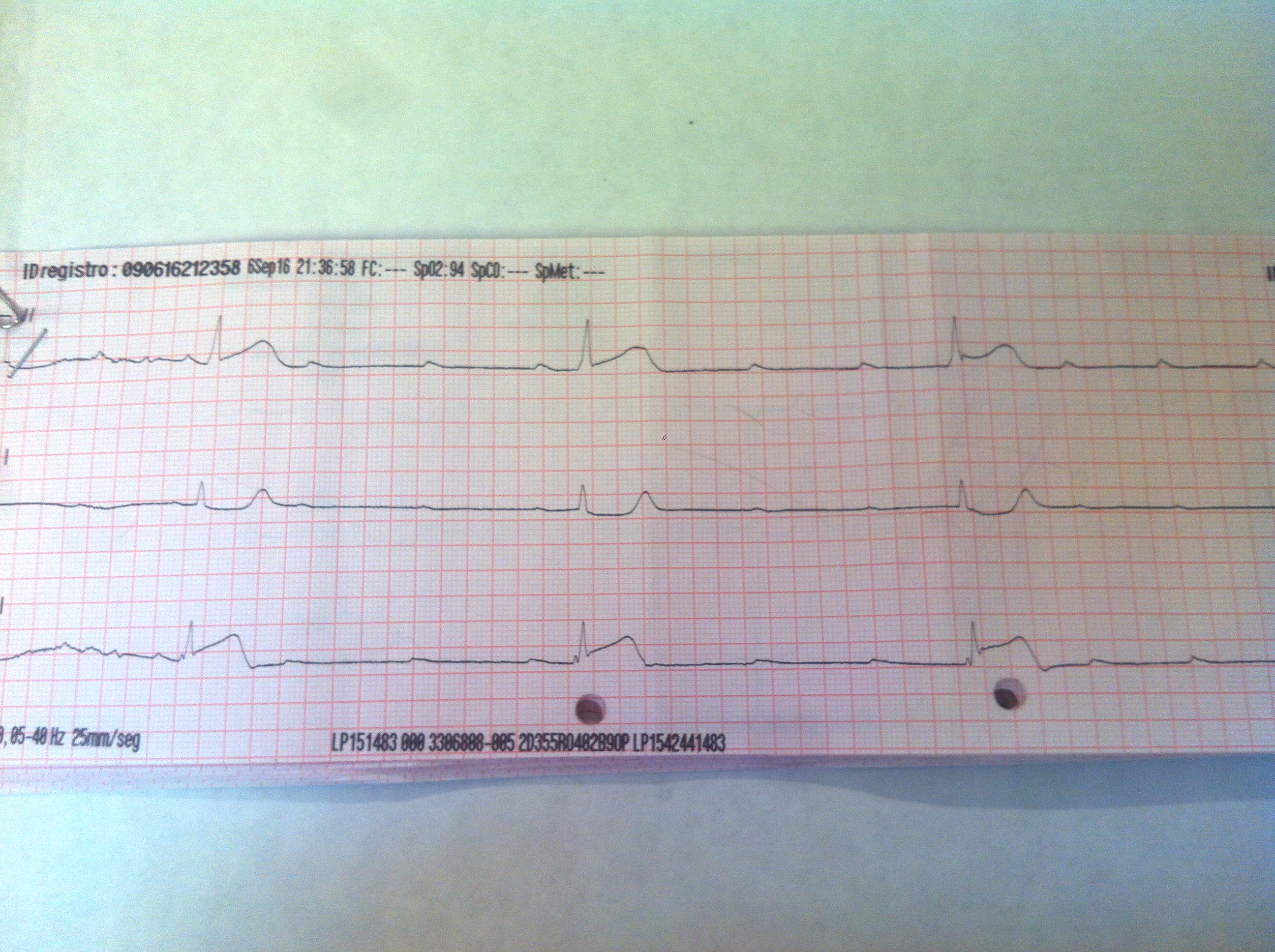 Bloqueo AV completo en IAM inferior. Caso 22 | cardiomap