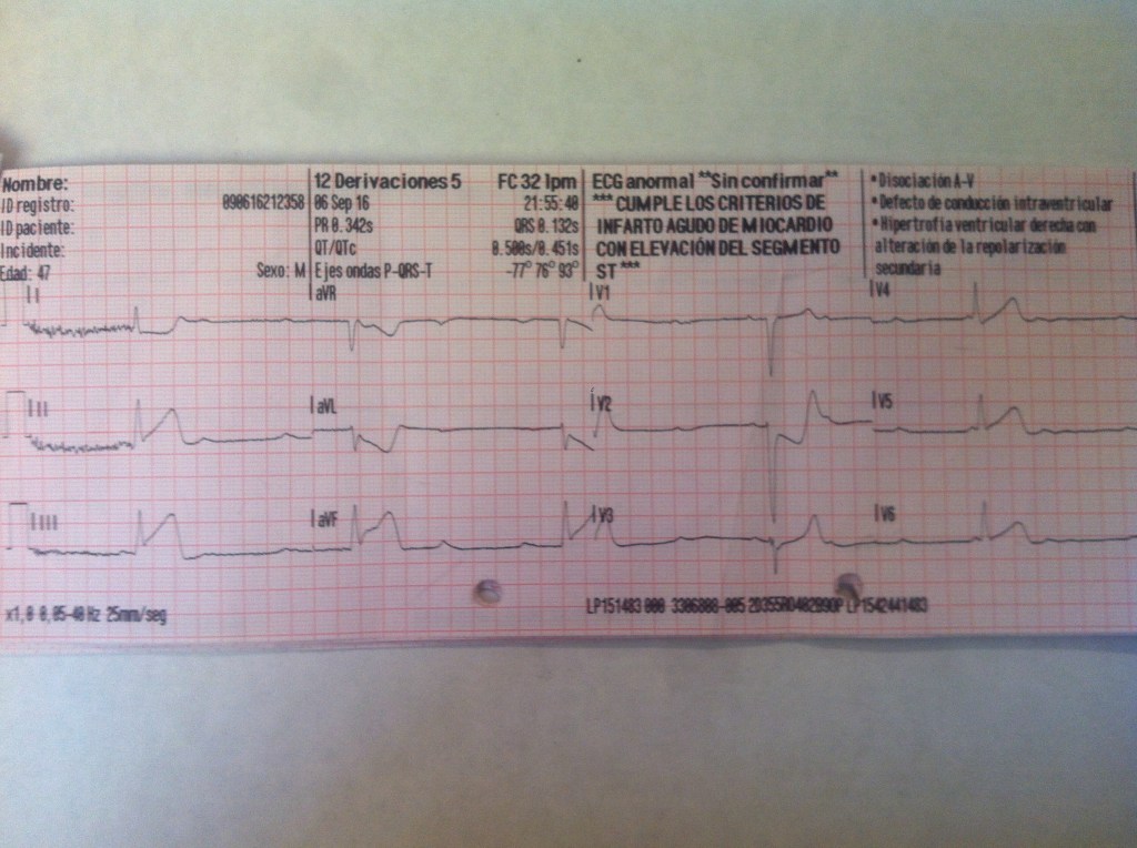 Bloqueo AV completo en IAM inferior. Caso 22 | cardiomap