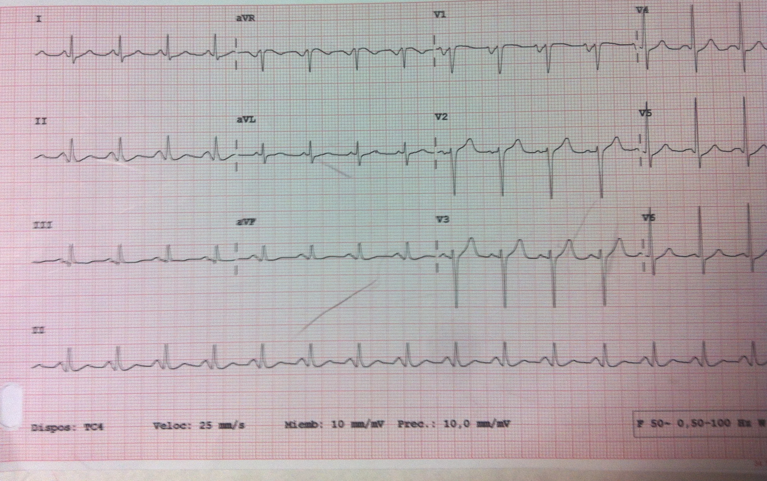 Flutter auricular!!! (II) Caso 29 | cardiomap