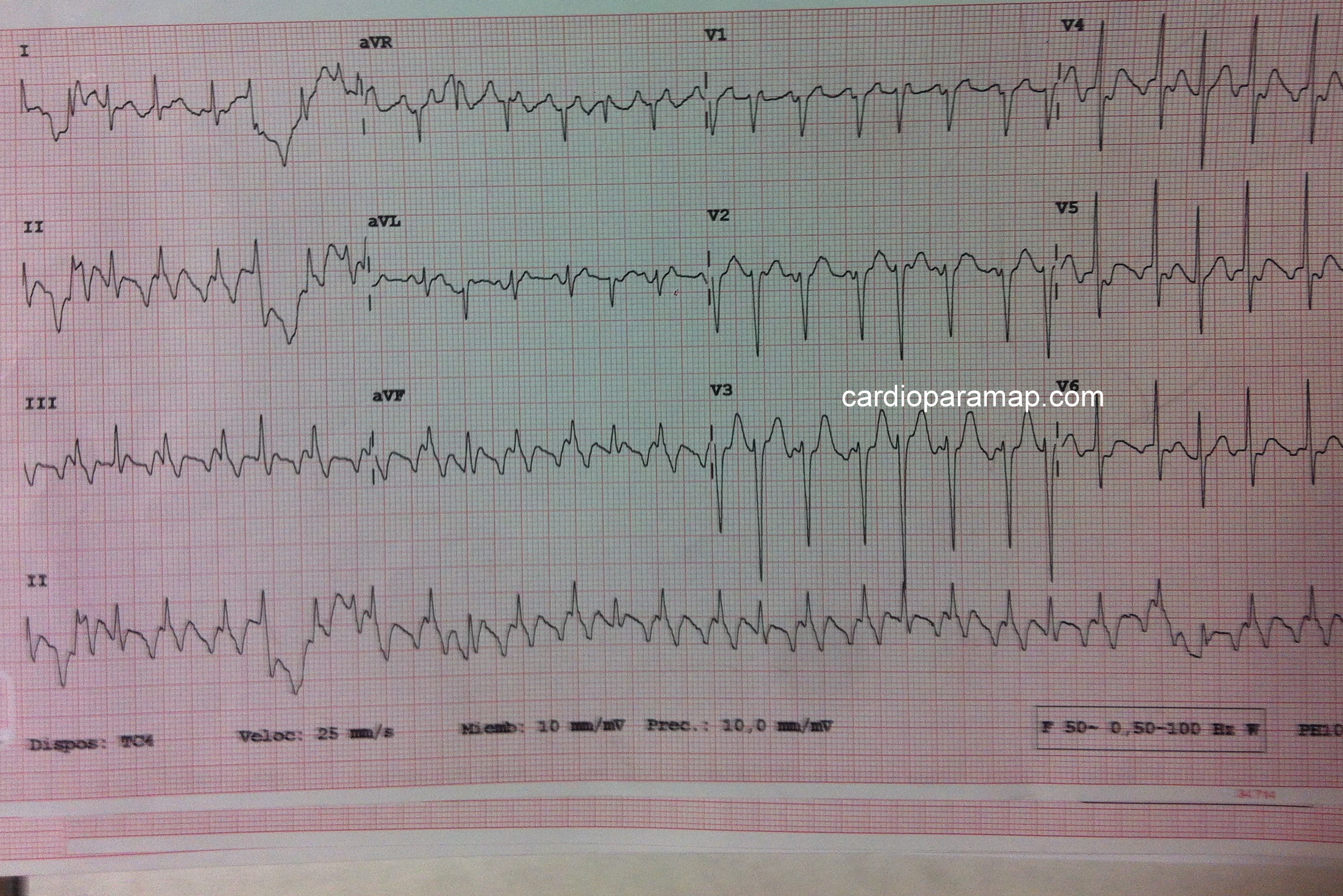 Flutter auricular!!! (II) Caso 29 | cardiomap