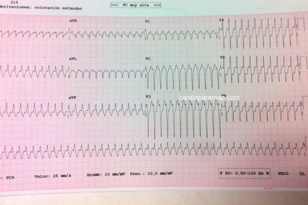 Flutter auricular!!! (II) Caso 29 | cardiomap