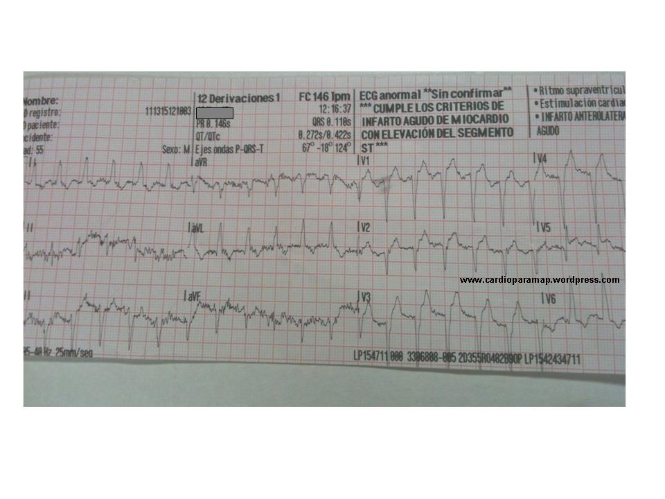 La importancia de tener a mano un ECG antiguo | cardiomap