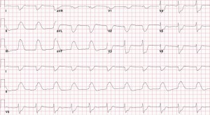 Signo de «Shark Fine» o «aleta de tiburón» en ECG. Caso 41 | cardiomap