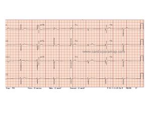 RITMO NODAL | cardiomap