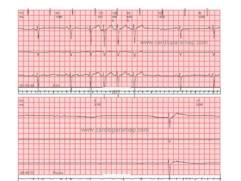 RITMO NODAL | cardiomap