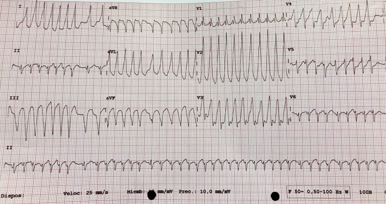 Taquicardia de QRS ancho y de QRS estrecho en el mismo paciente. Caso ...